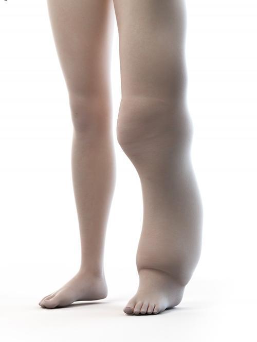 Do You Suffer from Lower Extremity Lymphedema?